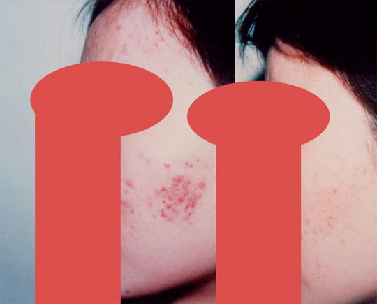 Skin Disease Treatment | TCM Acupuncture in Miami